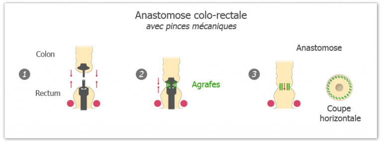 Colectomies - Chirurgie Viscerale Saint-Etienne